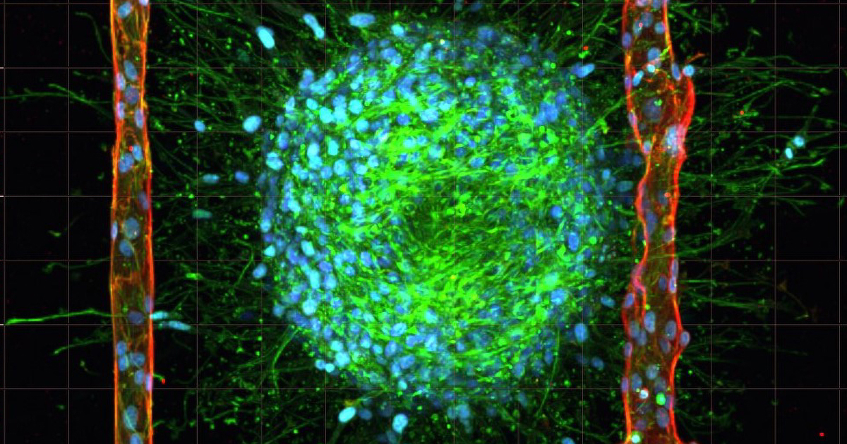 3D model of living brain cancer points to possible future for drug ...